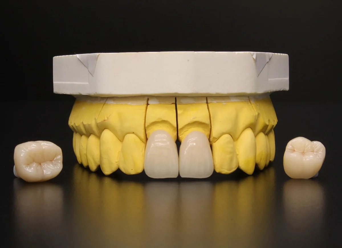 Оценка прочности соединения керамических масс со сплавом stomet – 1kz
